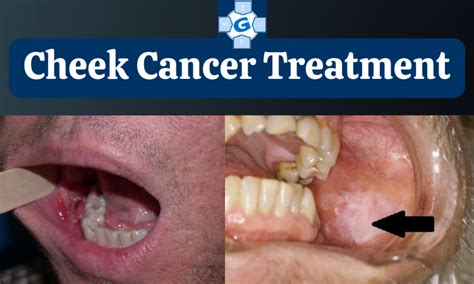 Understanding The Main Contributing Factors For Cheek Cancer