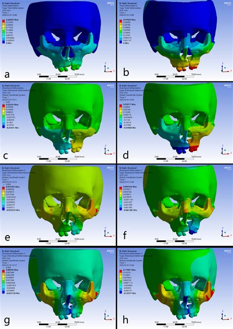 Displacement Patterns Of Craniofacial Structures In Frontal Views