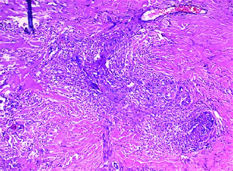 Photomicrograph Showing Diffuse Dense Infiltrate Of Neutrophils Download Scientific Diagram