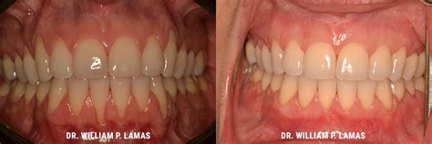 Receding Gums Before And After