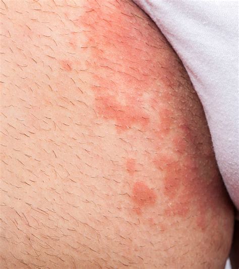 Inner Thigh Rash Male