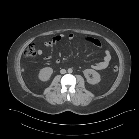 Radiopaedia Case Subhepatic Appendicitis Id 51297 Study 56974 Nc