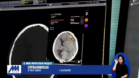 Хиймэл оюун ухаанд суурилсан программ эрүүл мэндийн салбарт нэвтэрч