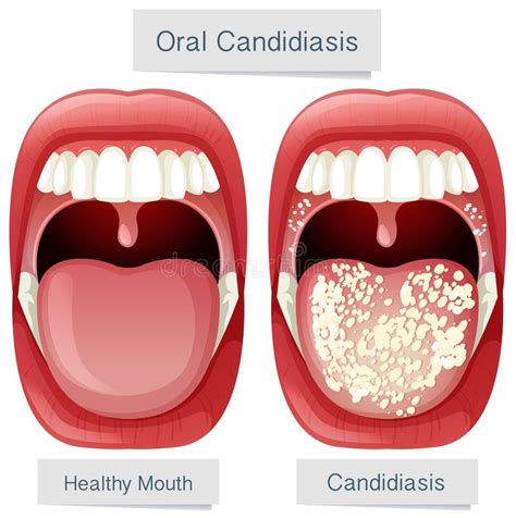 Oral Candidiasis Yeast Infection Ofl Candida Albicans The Mouth Stock Vector Illustration Of
