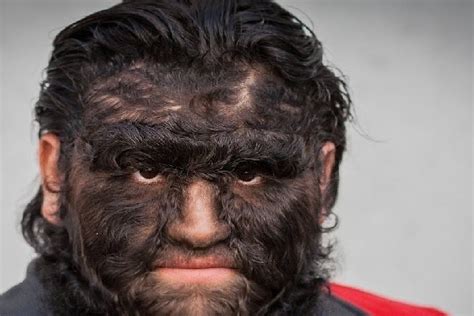 What Is Hypertrichosis Mycapil ️