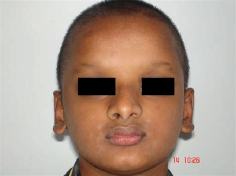 Figure 1 From Hypohydrotic Ectodermal Dysplasia A Case Report Semantic Scholar