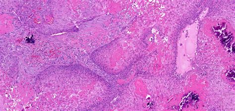 Pilar Cyst Histology