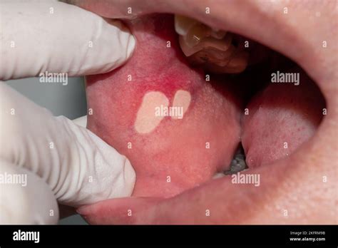 Aphthous Ulcers Throat
