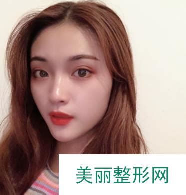 广州爱莱美郑燕妮老师的名声怎么样 韩式带双眼皮的外壳 美嘉整形网 美学知识
