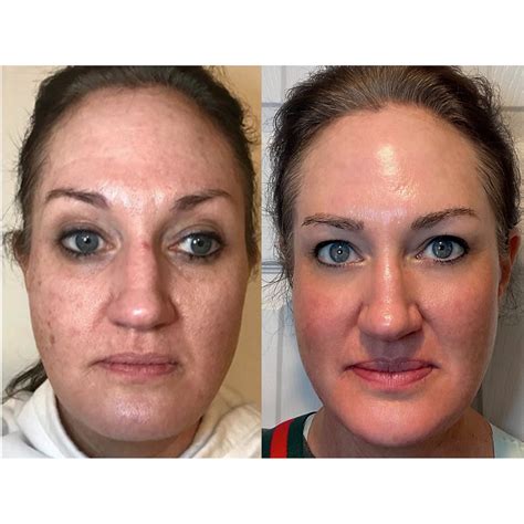 Microtox Facials Dutch Hollow Medical