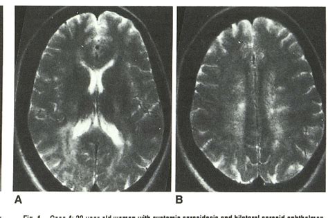Figure 4 From High Signal Periventricular Lesions In Patients With