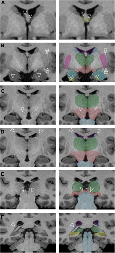 Frontiers Anatomically Curated Segmentation Of Human Subcortical Structures In High Resolution