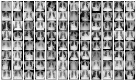NIH Chest X Ray Dataset Mirror Of Https Huggingface Co Datasets