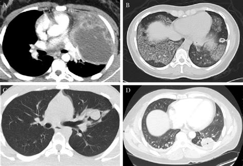 Chest Ct Scans Of New Cases Of Cryptococcal Infection In Patients With Download Scientific