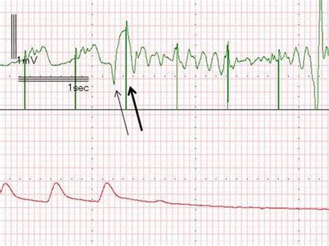 Ecg And Pressure Waveform During The Second Episode Of Ventricular