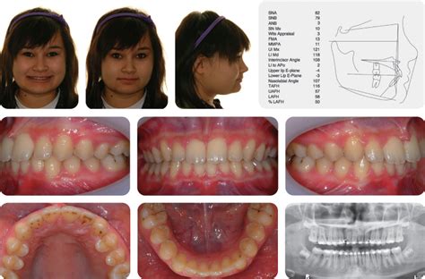 4 Class Ii Division 1 Malocclusion Pocket Dentistry