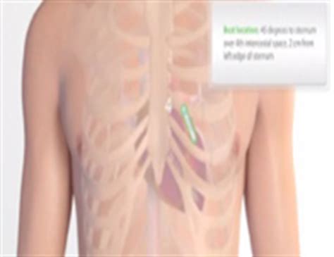 Implantable Loop Recorder Ruth Kam Heart Arrhythmia Clinic