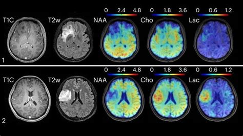 mri technique detects brain disease by mapping metabolism technology
