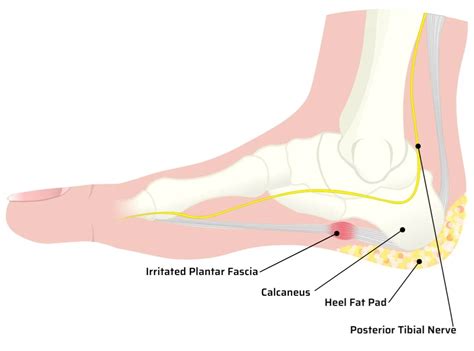 Why Does My Heel Hurt When I Walk — Physiotherapy London Ontario