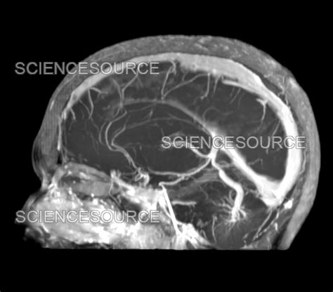 Large Developmental Venous Anomaly Mr Stock Image Science Source Images