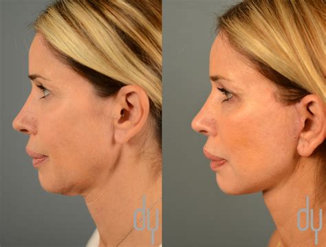 Facelift Before And After Deep Plane Facelift Recovery Beverly