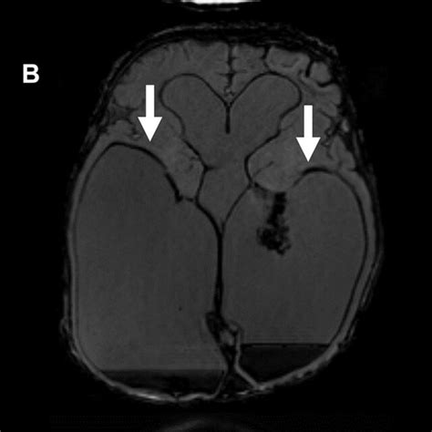 Three Patients Axial Cross Sections Of Susceptibility Weighted Imaging