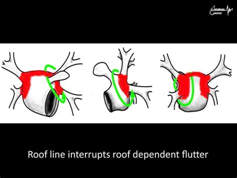 Ablation Of Atypical Flutter Pptx