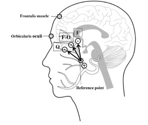 Facial Nerve Mapping Performed Preoperatively The Anode Was The