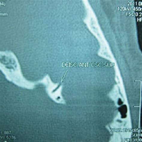 Left Superior Semicircular Canal Dehiscence As Seen On Coronal Temporal