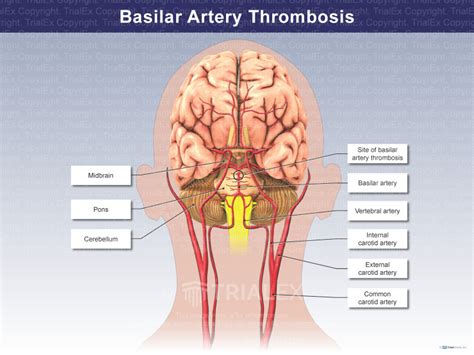 Basilar Artery Patient With Basilar Artery Occlusion Related To