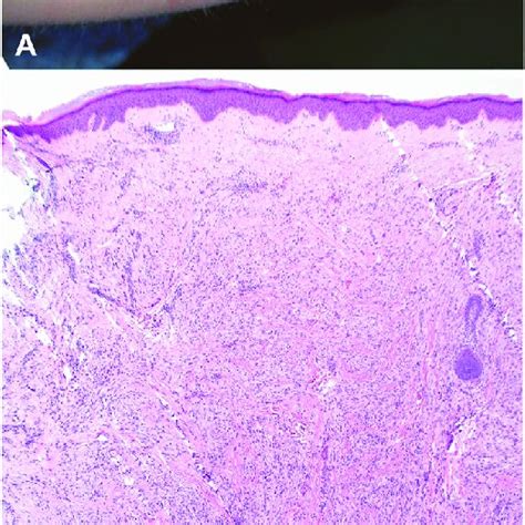 A The Lesion Was An 8 Mm Nondescript Pink Nodule Seen Here With A