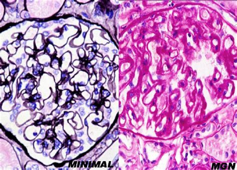 Normal Glomerulus Left And Membranous Glomerulopathy Right