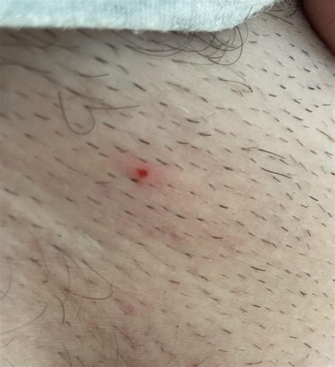 Std Ingrown Hair Or Pimple R Askdoctorsmeeee
