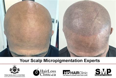 Scalp Treatment Toronto HairTattoo