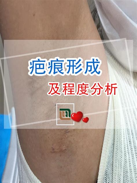 疤痕形成及程度分析 知乎