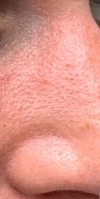 Yag Laser Before And After Photos Vein And Aesthetics Center