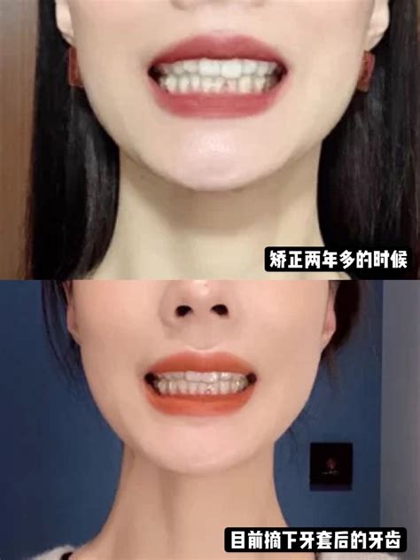 咬合不正怎么矫正 咬合不正导致的嘴歪图 伤感说说吧