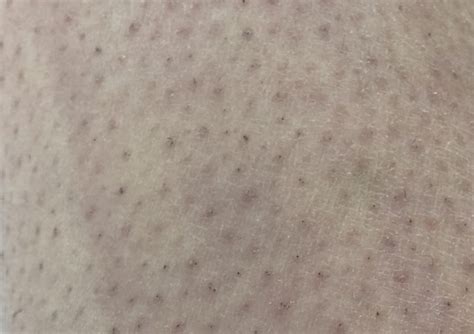 How To Get Rid Of Razor Bumpson Legs At Roscoe Ramirez Blog