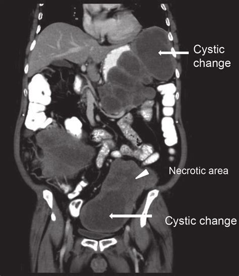 Coronal Contrast Enhanced Ct Image Showing Large Exophytic Gastric