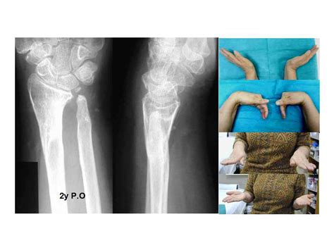 桡骨远端骨折治疗流程 医学文章 唯医 allinmd
