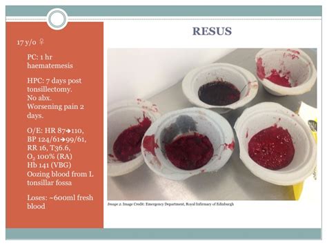Tonsillectomy Bleeding