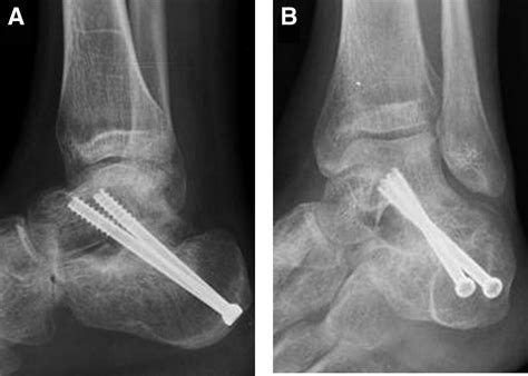 Arthroscopic Subtalar Arthrodesis Using A Posterior 2 Portal Approach