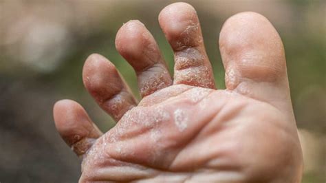 5 Reasons Why Your Feet Are Peeling Feet First Clinic