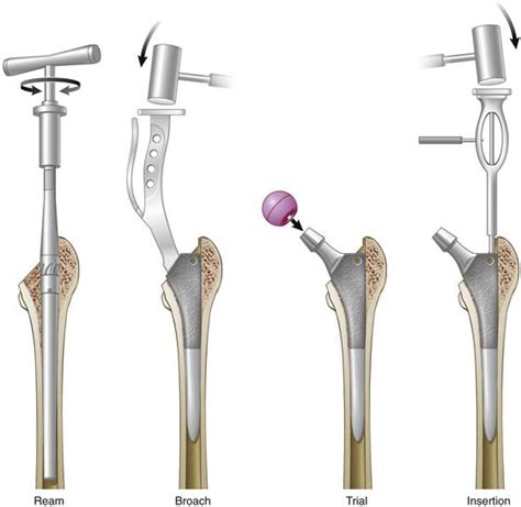 Uncemented Tapered Femoral Components Musculoskeletal Key