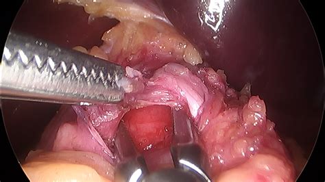 Heller Myotomy For Achalasia Virginia Heartburn And Hernia Institute