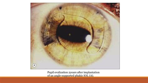 Phakic Iol Ppt Pptx