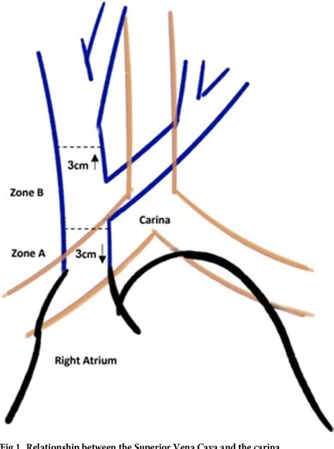 Figure 1 From Central Catheter Tip Migration In Critically Ill Patients Semantic Scholar