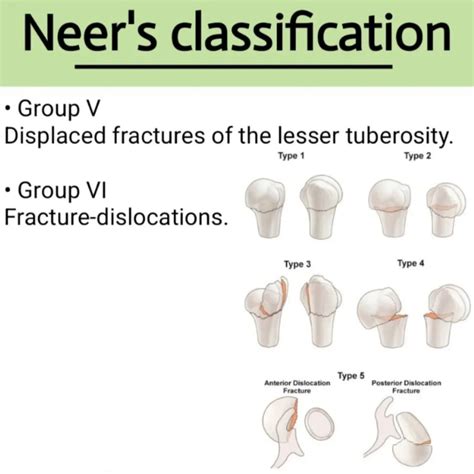 Proximal Humerus Fracture Classification Three Dimensional Printing