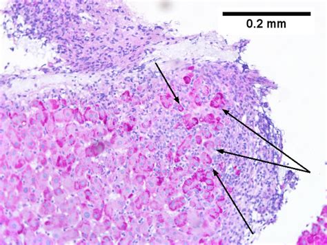 Hepatitis B Libre Pathology
