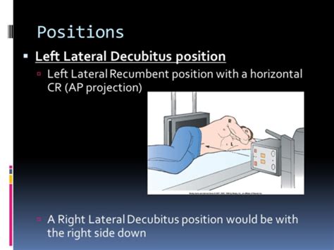 Left Lateral Decubitus Position